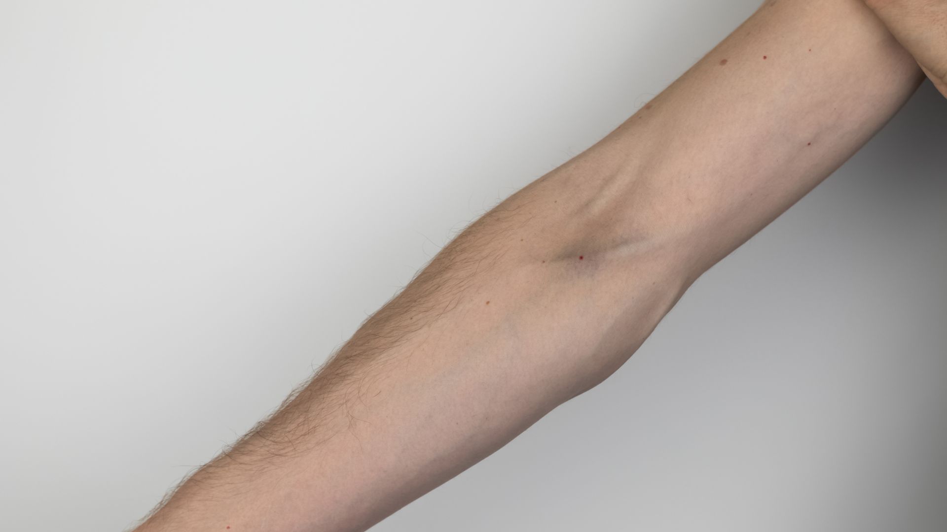 Track Marks: Appearance & Signs of IV Drug Use